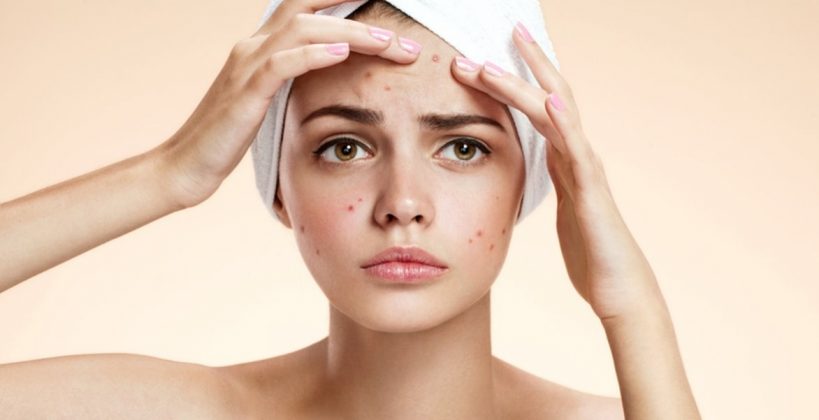 How to get rid of blackheads on face - upsmash