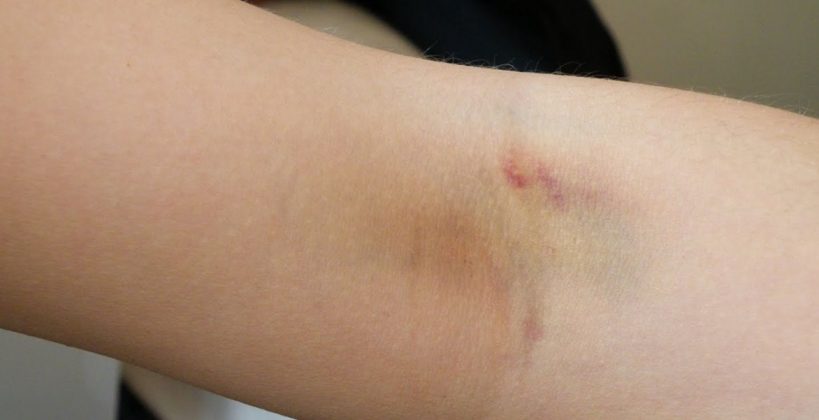 How to Get Rid of Bruises Instantly - upsmash